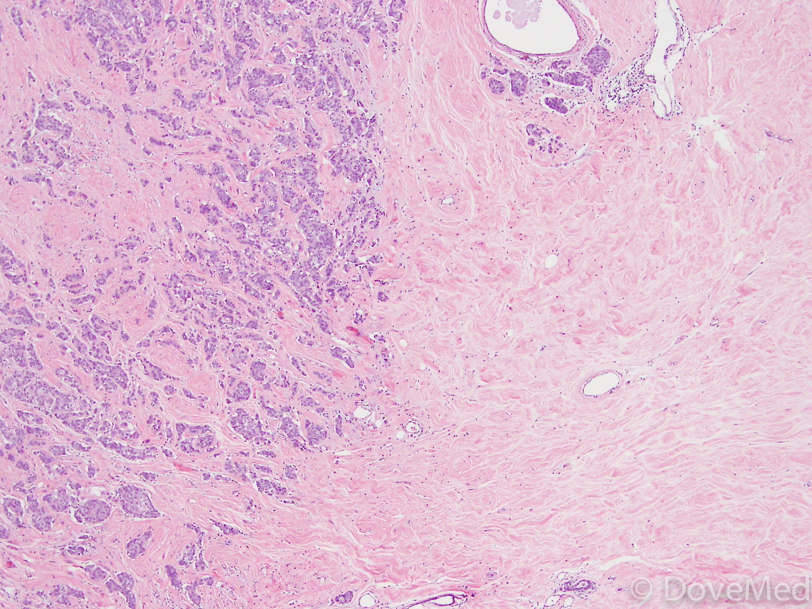 Invasive Ductal Carcinoma of Breast (NOS)