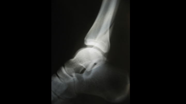 Stress Fracture of the Ankle