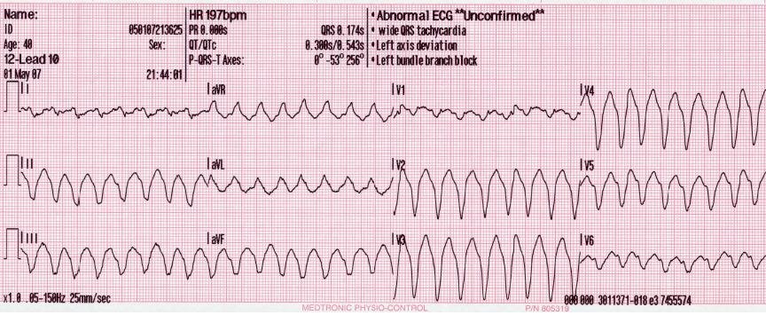 Paroxysmal Supraventricular Tachycardia (PSVT)