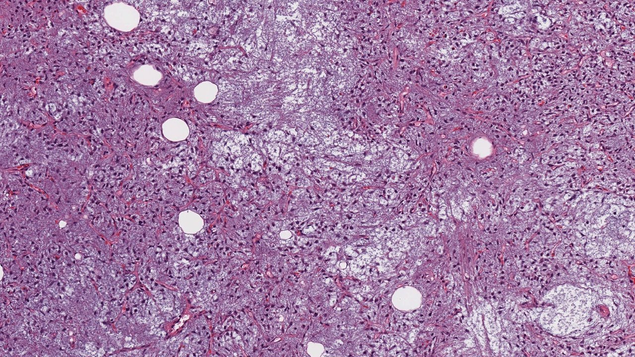 Myxoid Liposarcoma