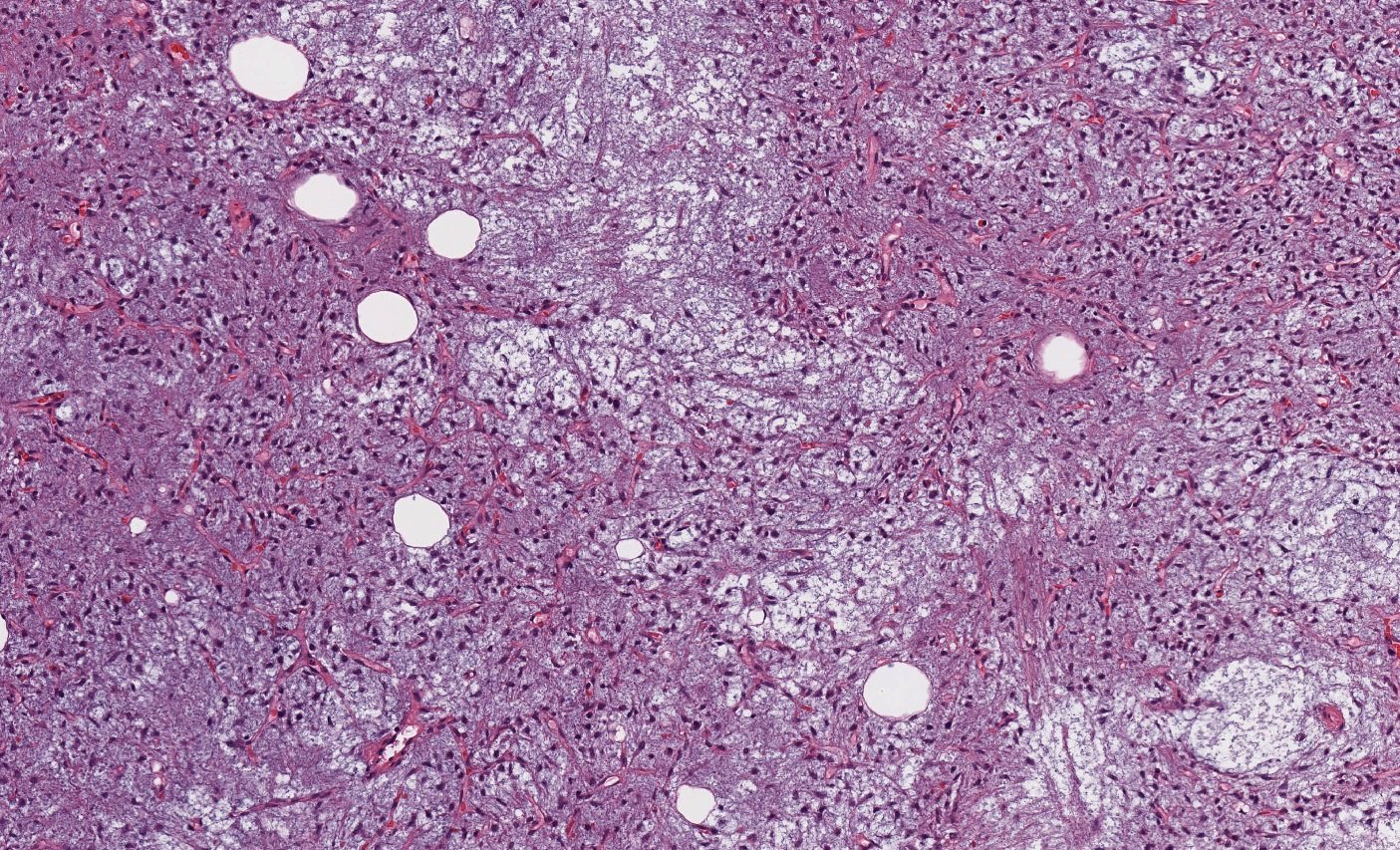 Myxoid Liposarcoma