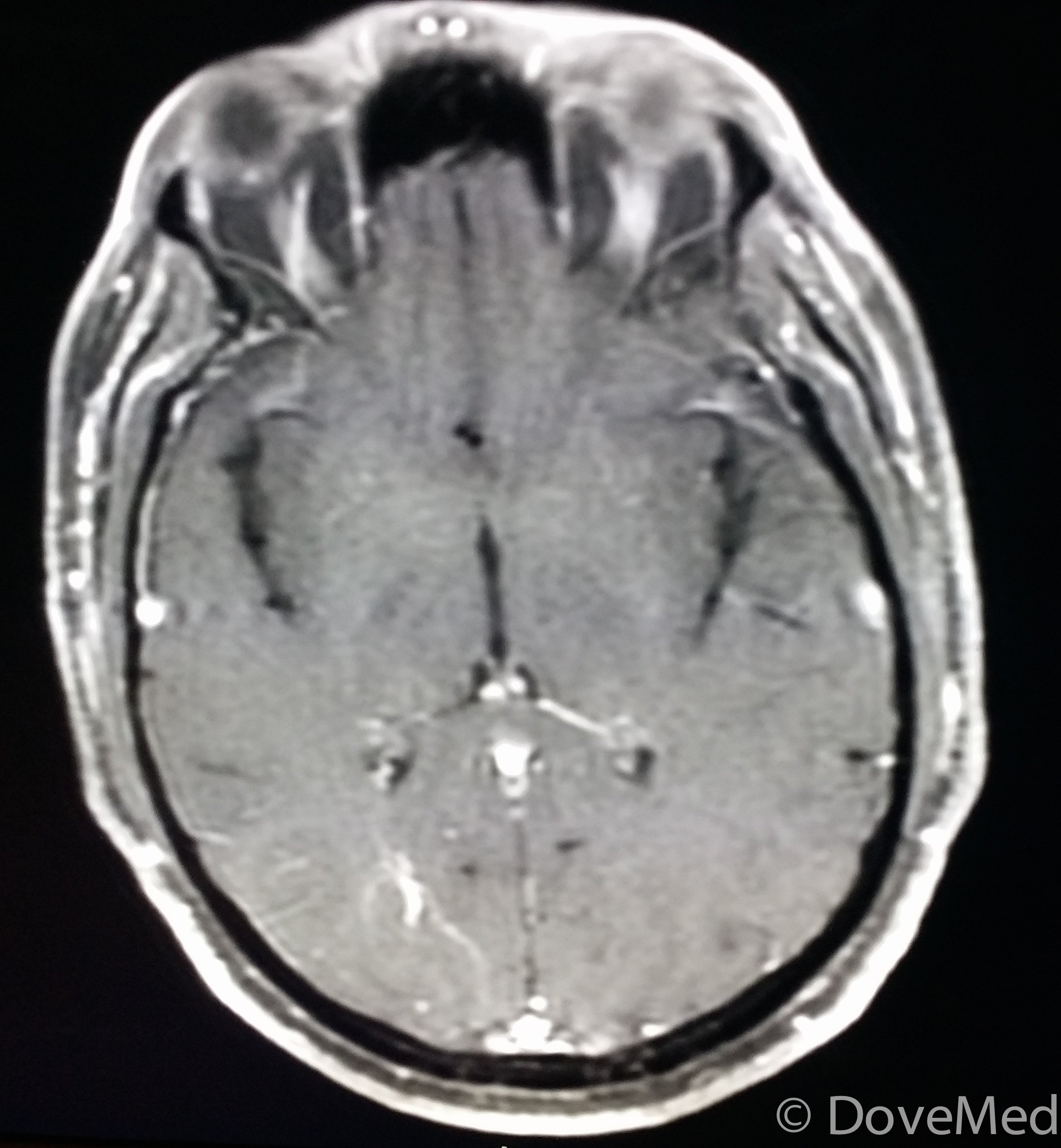 Magnetic Resonance Imaging (MRI) - Head