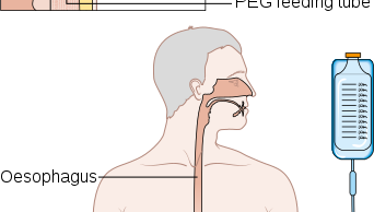 Percutaneous (through the skin) Endoscopic Gastrostomy (PEG Procedure)