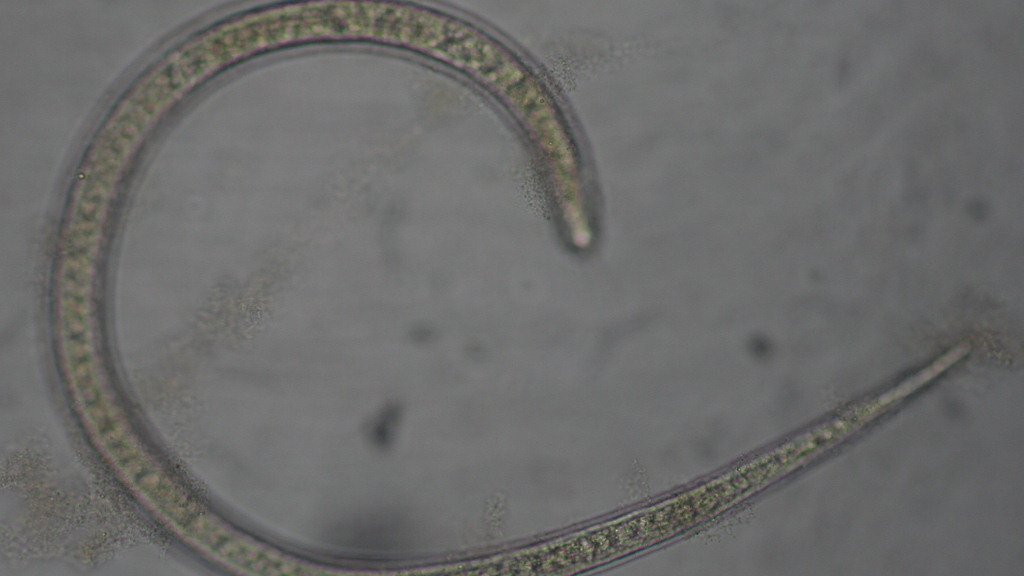 Trichinosis Infection