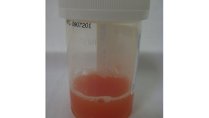 Synovial Fluid Analysis of Ankle Joint