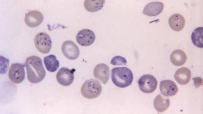 Babesiosis
