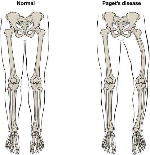 Facts About Pagets Disease Of The Bone