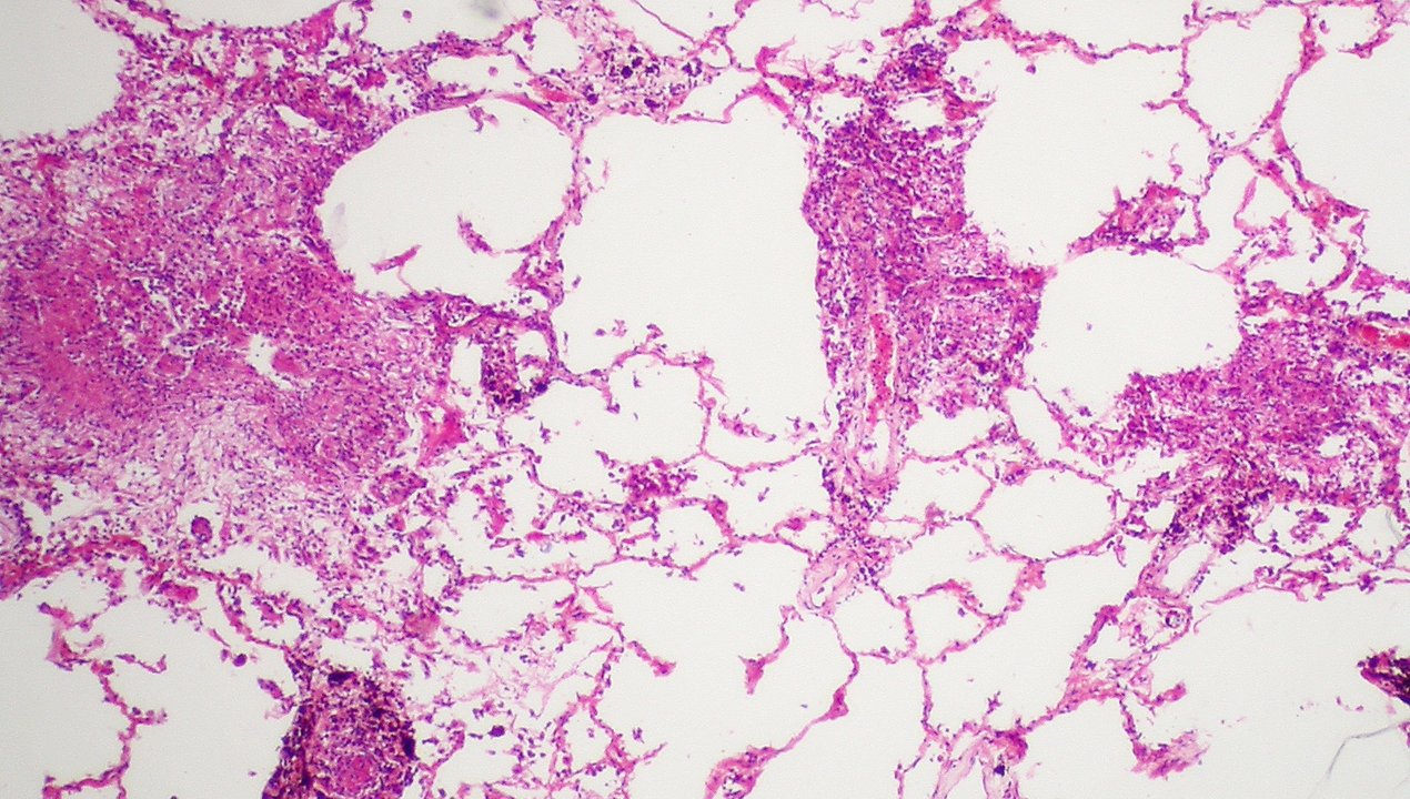 Disseminated Tuberculosis