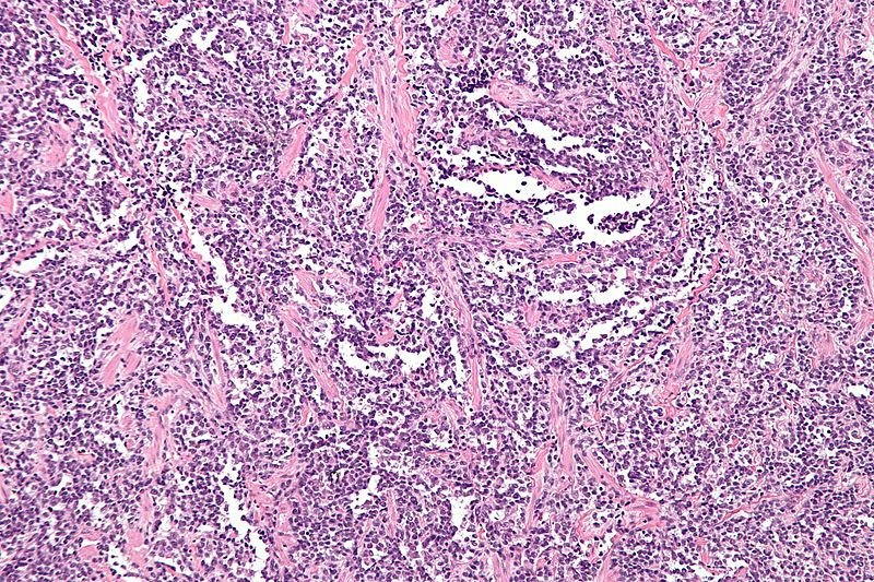 Alveolar Rhabdomyosarcoma (ARMS)