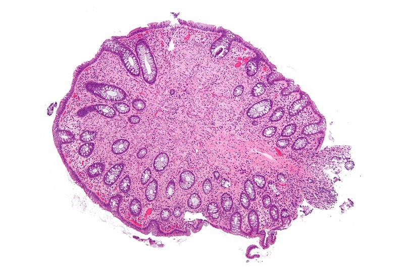 Ganglioneuroma