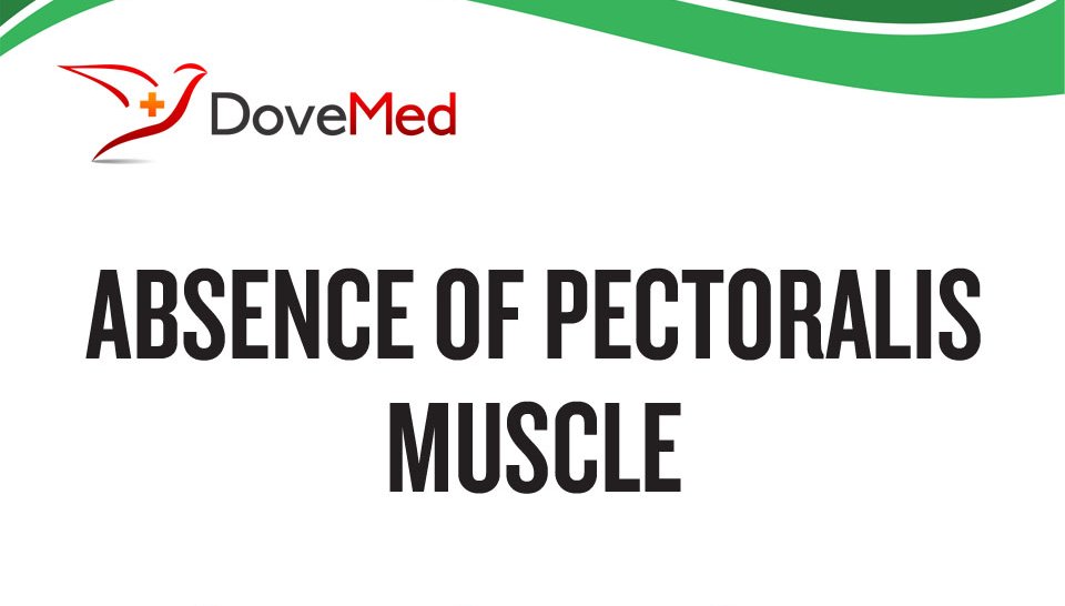 Absence of Pectoralis Muscle (due to Poland Syndrome)
