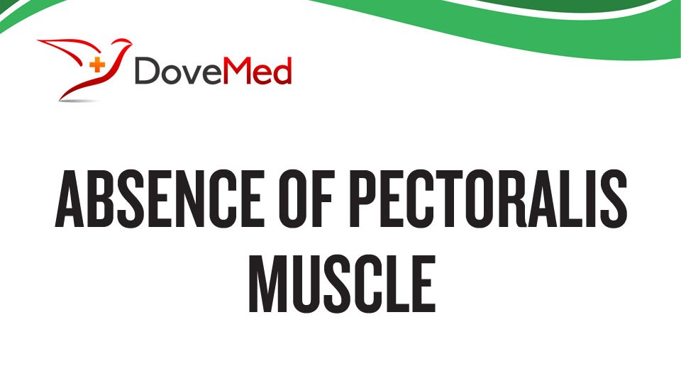 Absence of Pectoralis Muscle (due to Poland Syndrome)