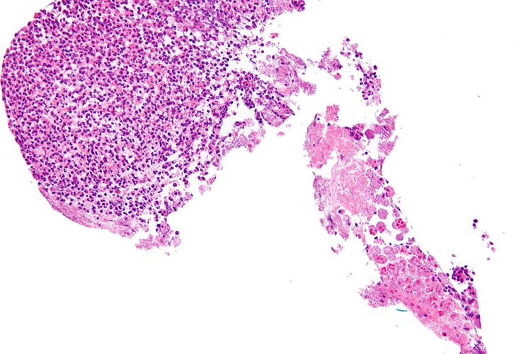 Facts about Amebiasis