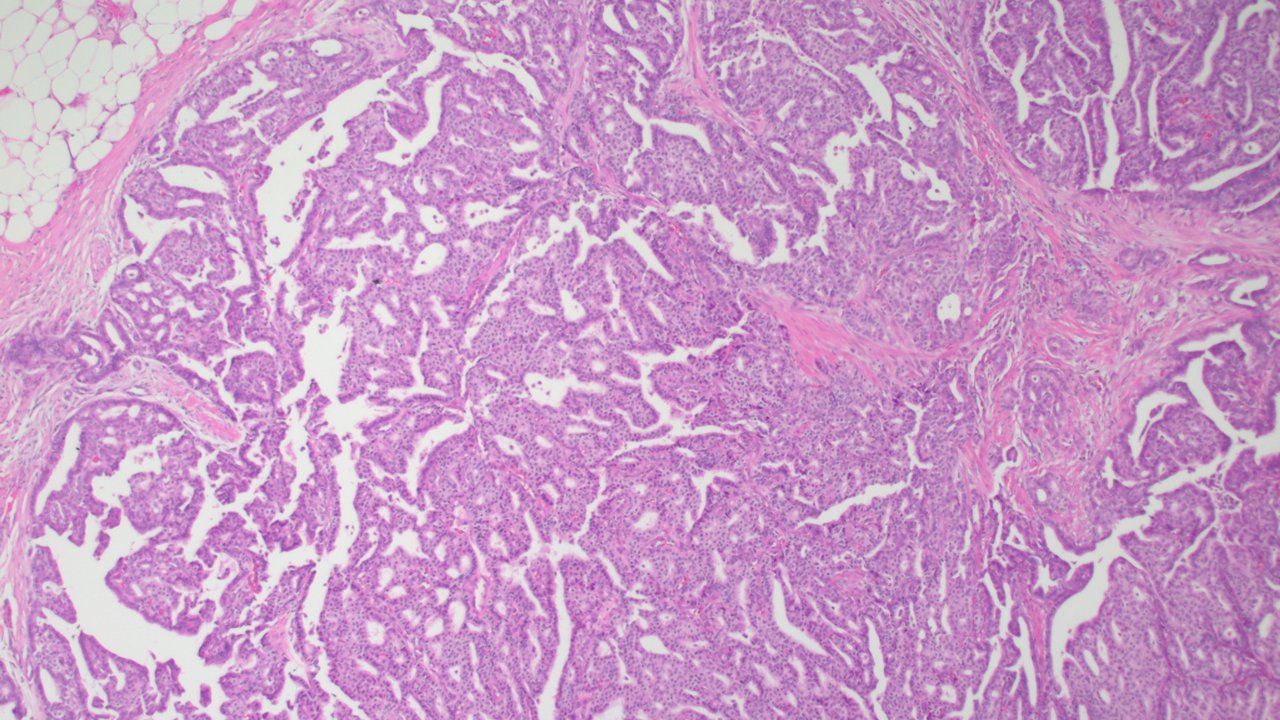 Invasive Papillary Carcinoma of Breast