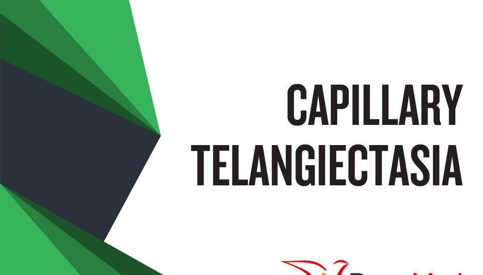 Capillary Telangiectasia