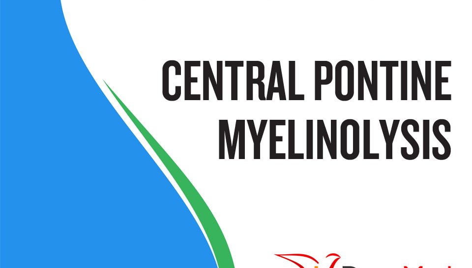 Central Pontine Myelinolysis
