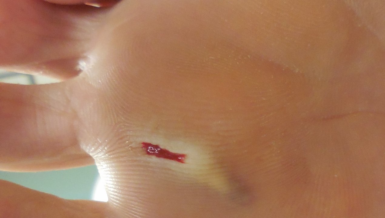 First Aid for Foreign Object in the Skin