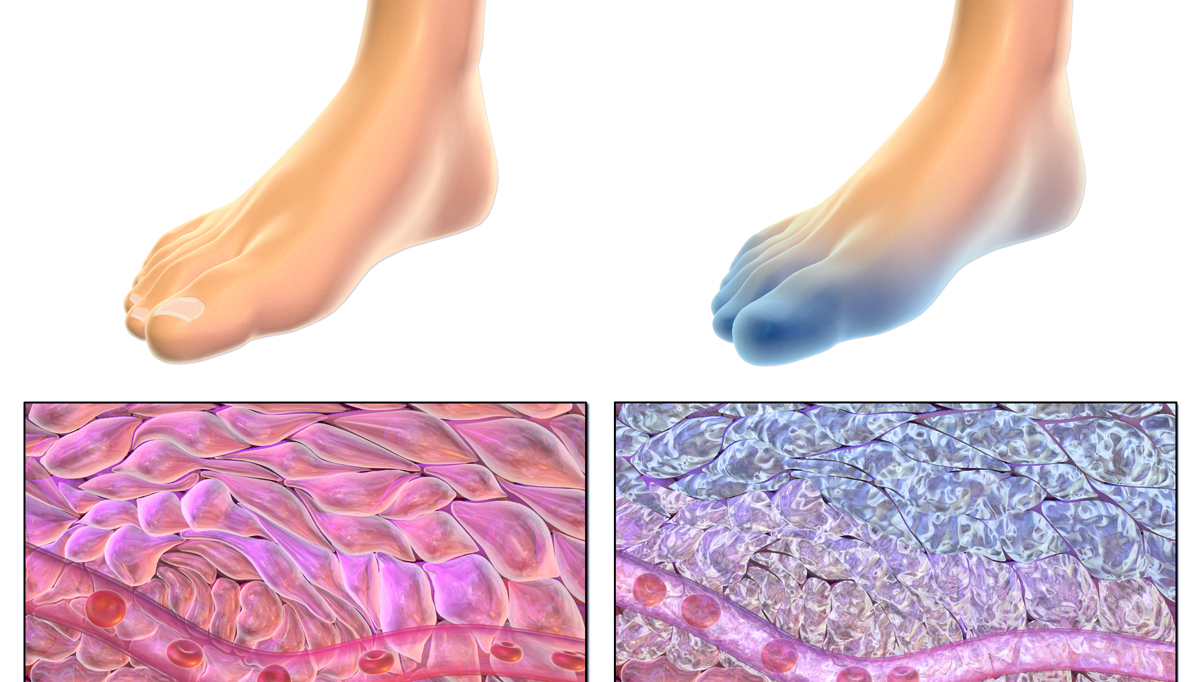 First Aid for Frostbite