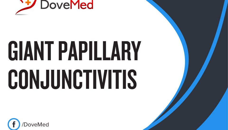 Giant Papillary Conjunctivitis (GPC)