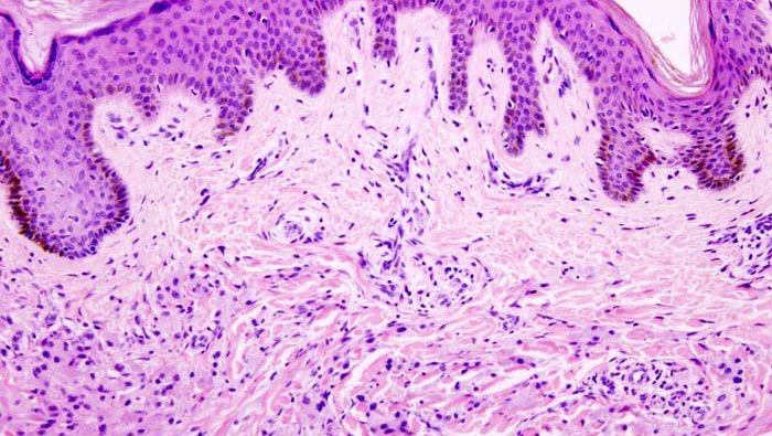 Granular Cell Tumor (GCT)
