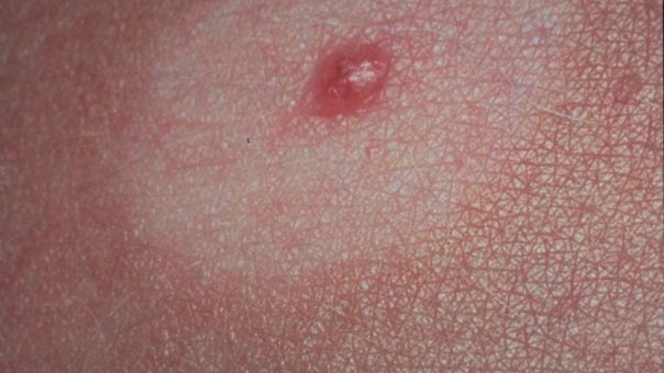 Halo Nevus