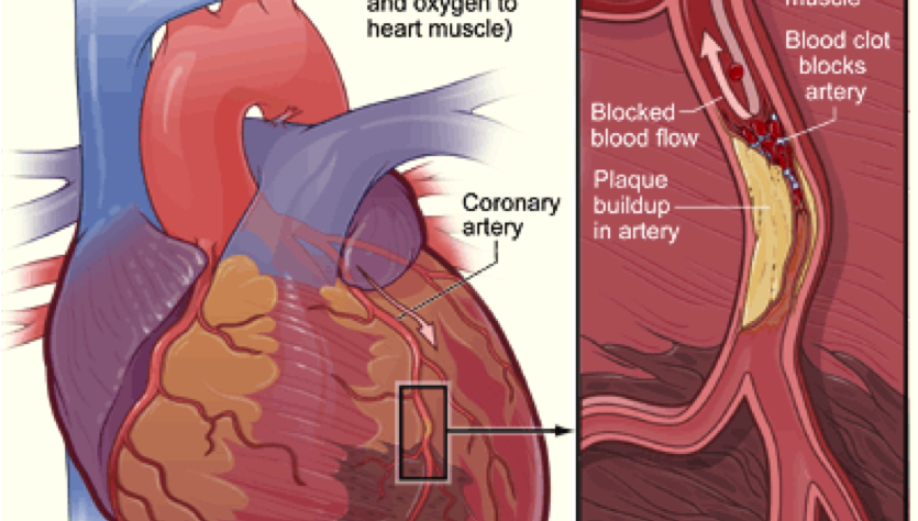 New Drug Protects Heart From Cardiac Rupture After Myocardial Infarction