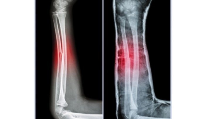 Fracture of the Ulnar Bone