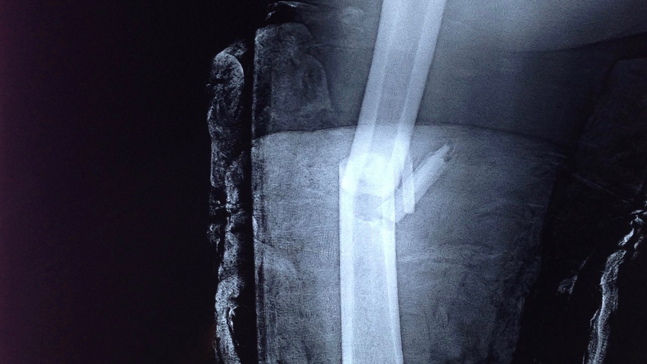 Fracture of the Femoral Shaft
