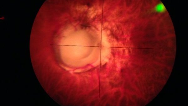 Morning Glory Syndrome