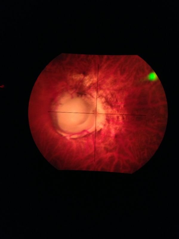 Morning Glory Syndrome