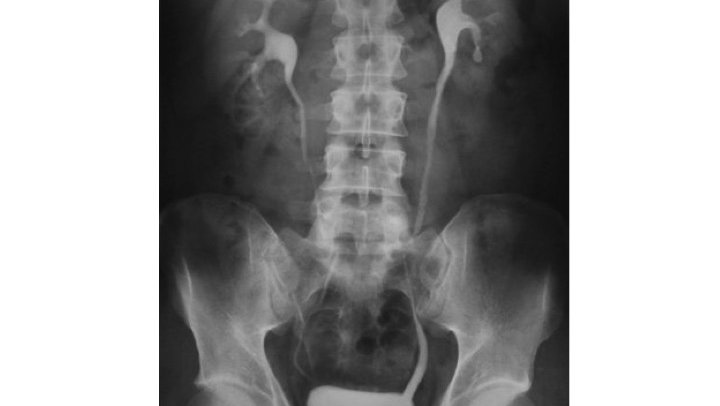 Intravenous Pyelogram