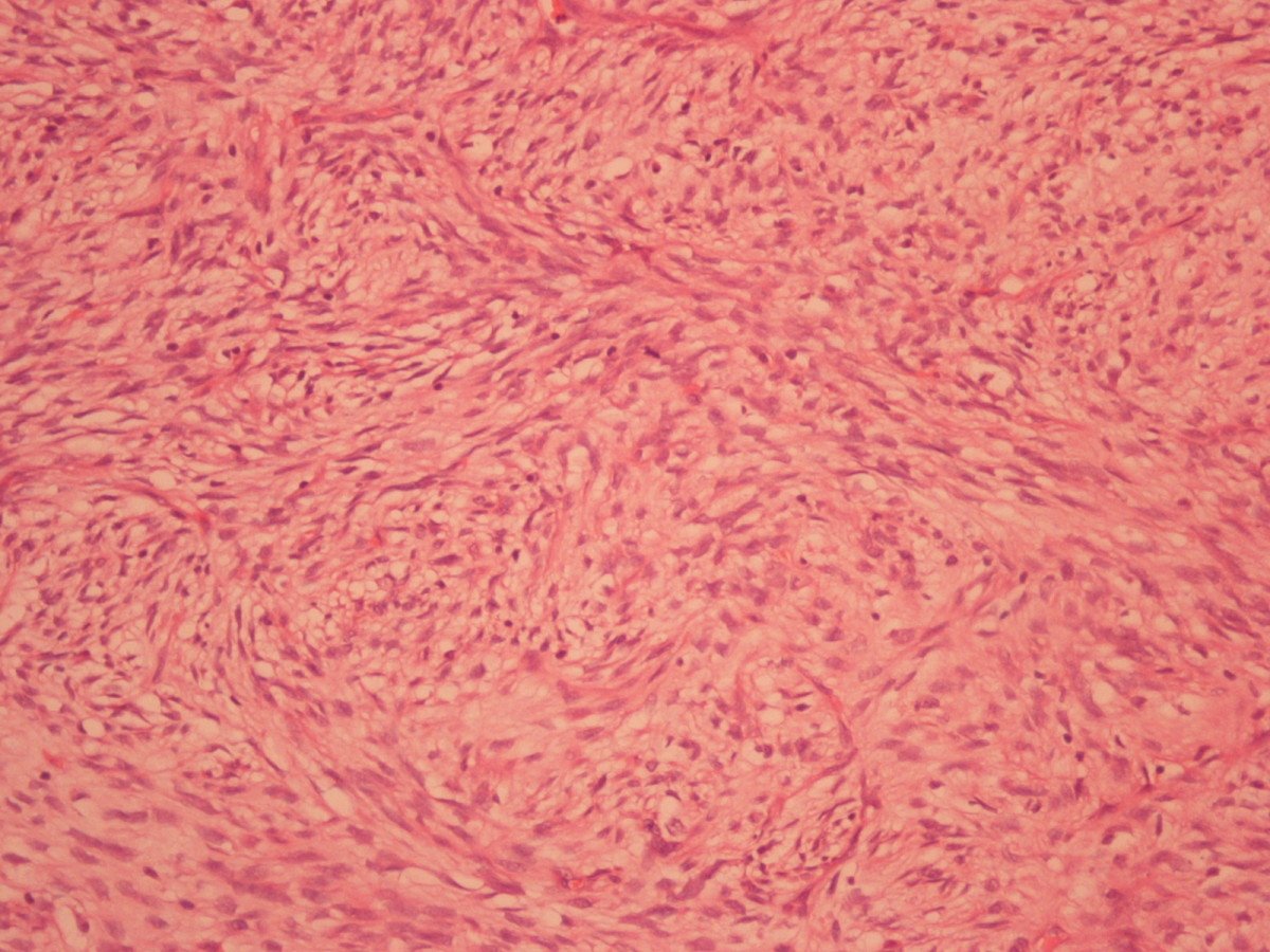 Well-Differentiated Liposarcoma