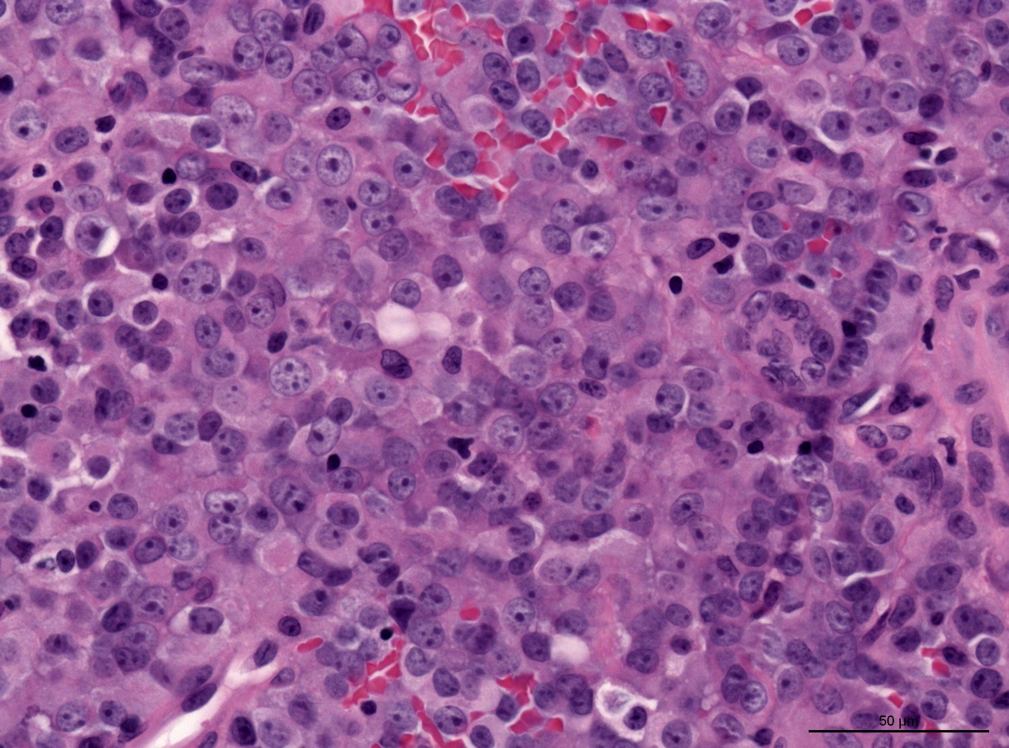 Extrarenal Rhabdoid Tumor (ERRT)
