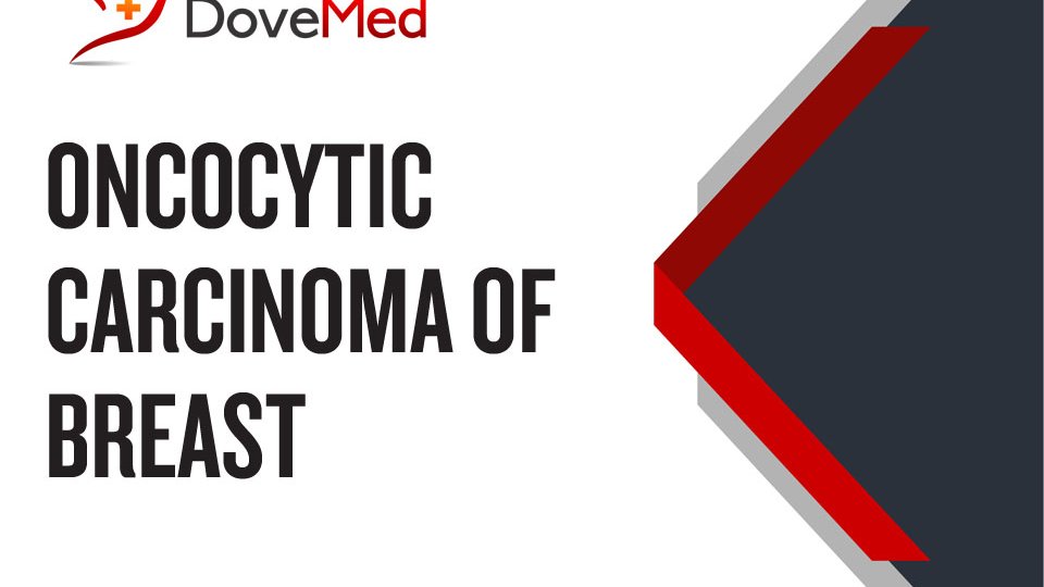 Oncocytic Carcinoma of Breast