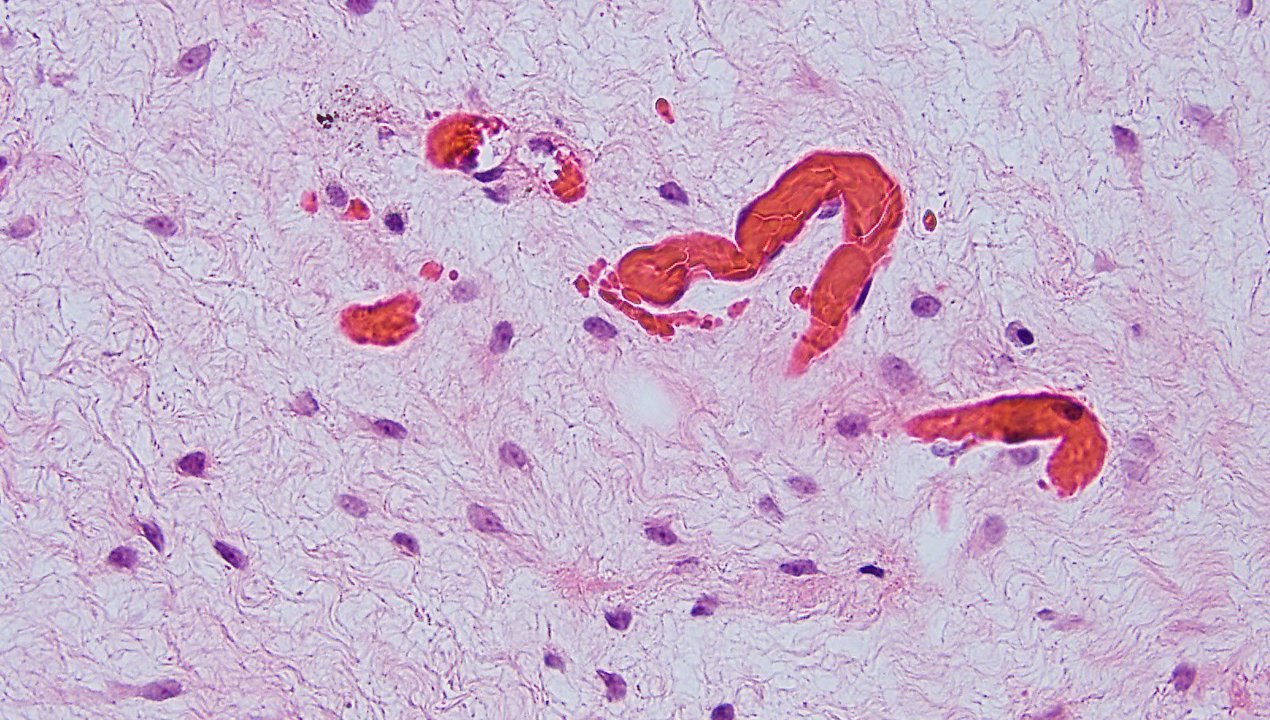 Deep Aggressive Angiomyxoma