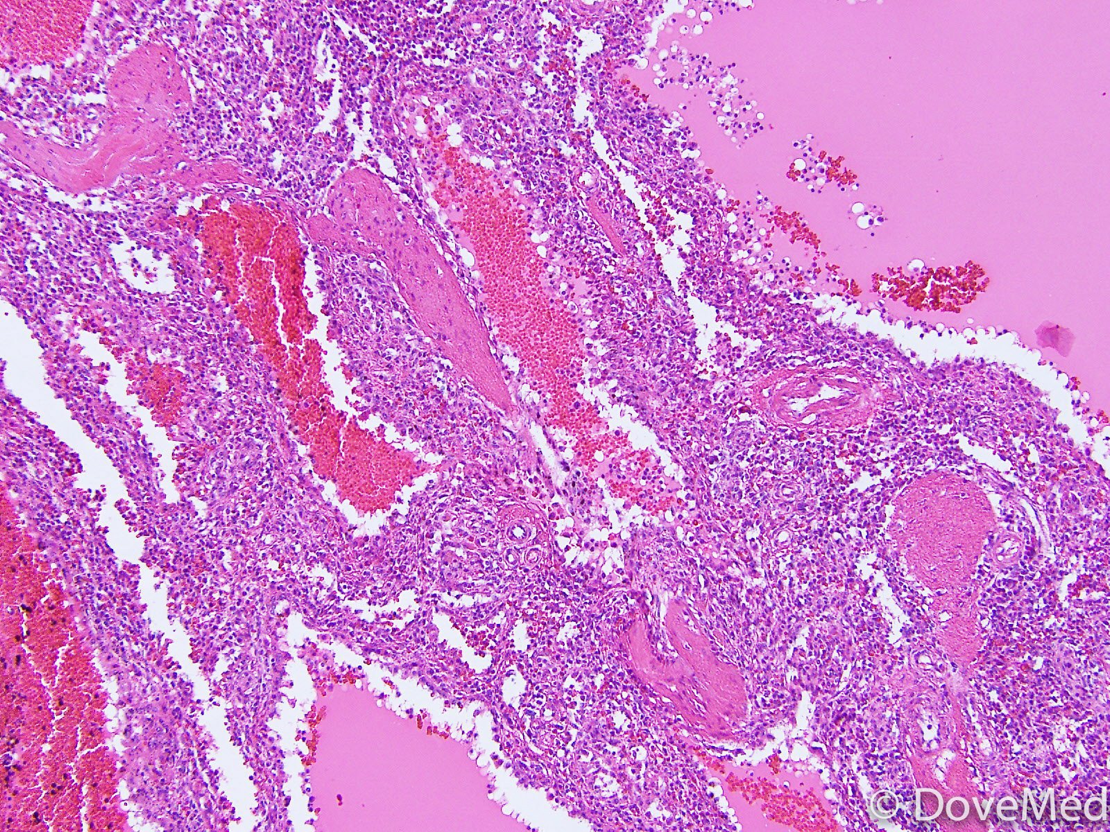 Littoral Cell Angioma of Spleen