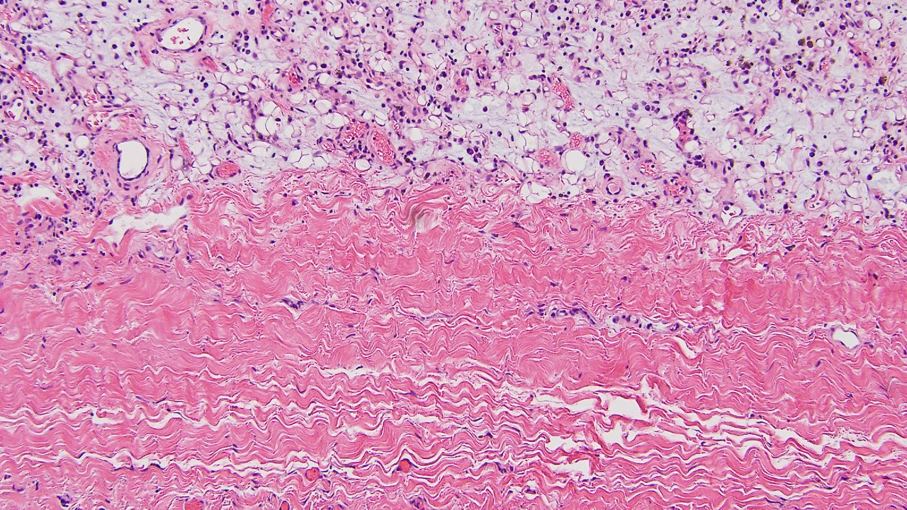 Non-infectious Pericarditis