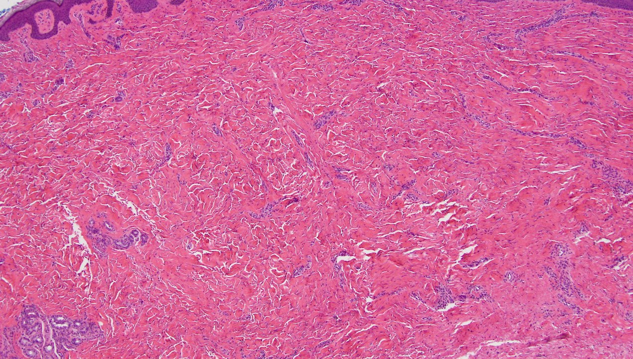 Limited Systemic Scleroderma