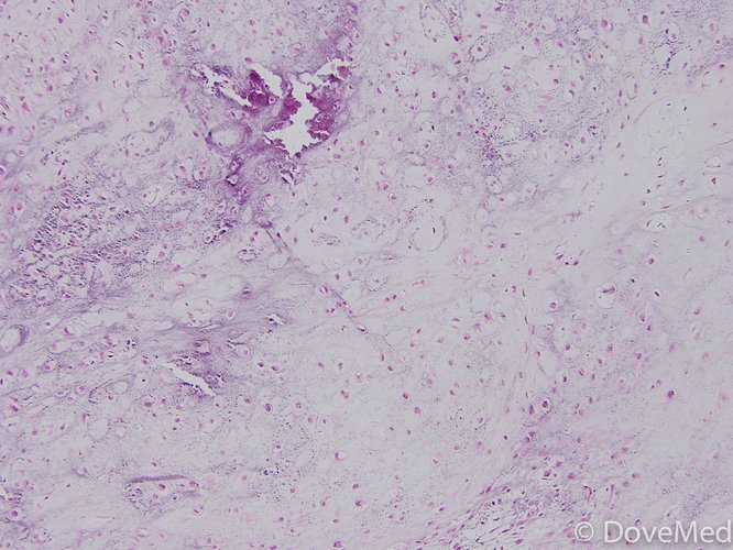 Facts about Soft Tissue Chondroma