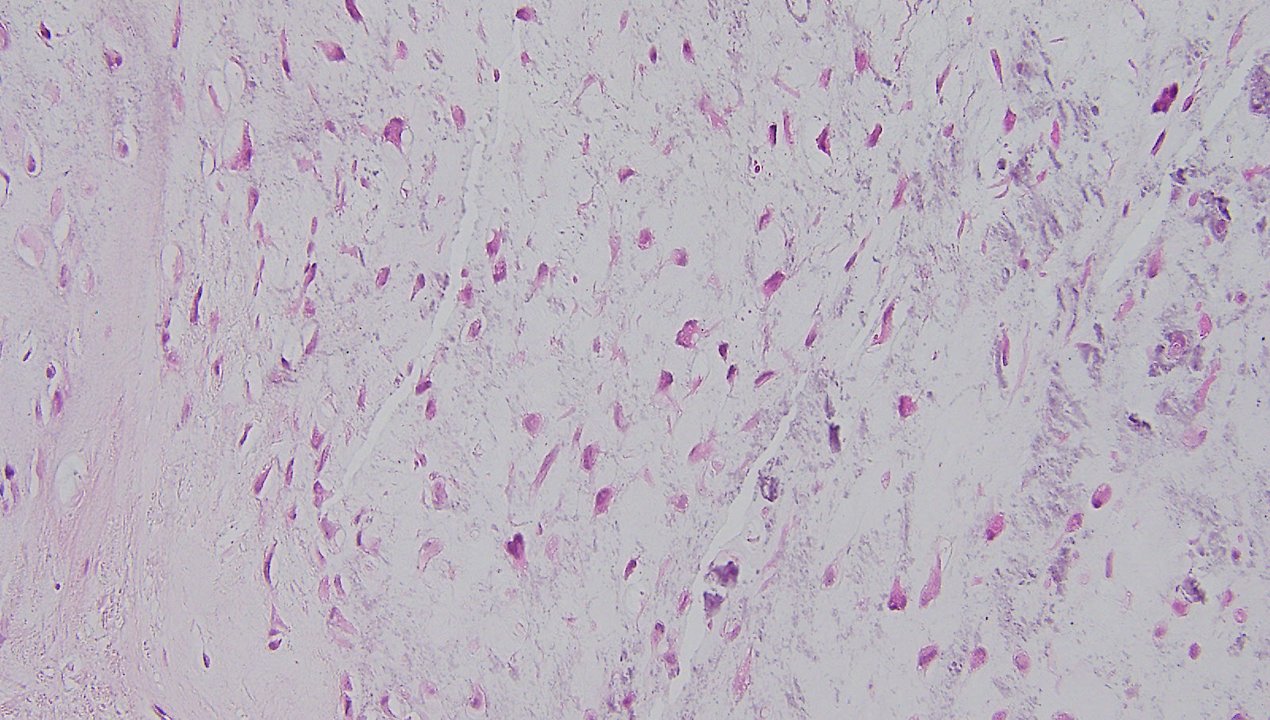 Soft Tissue Chondroma