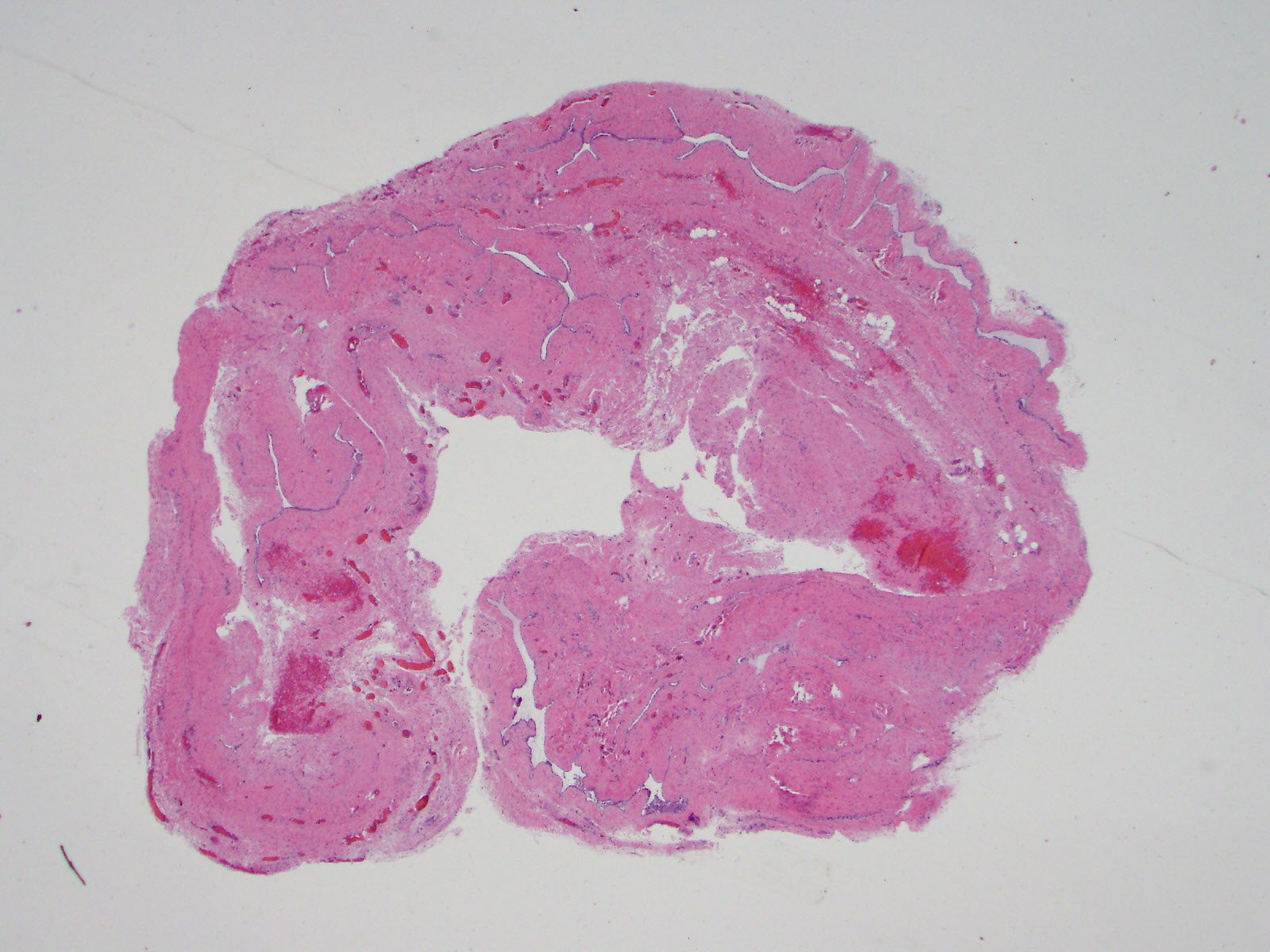 What causes a hydrocele?