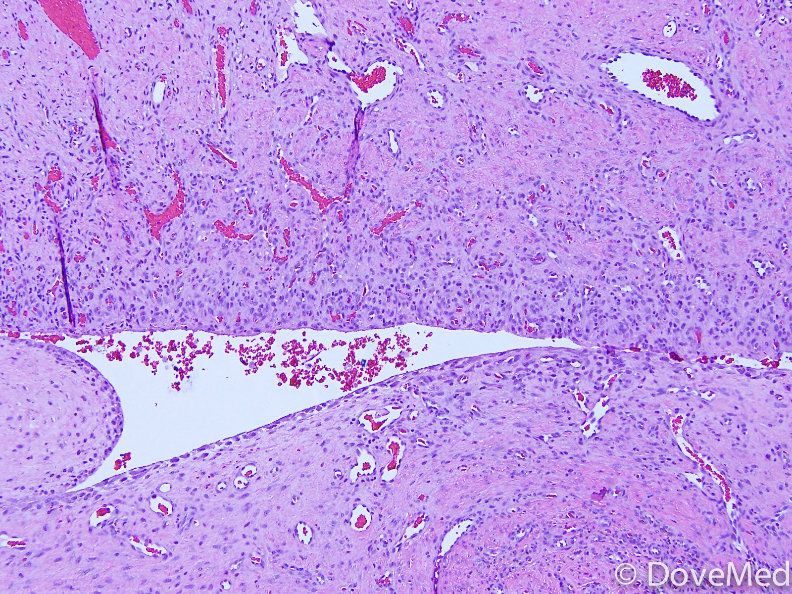 Angiofibroma of Skin