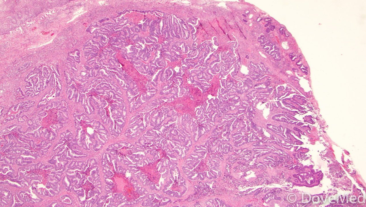 Adenocarcinoma of Cervix