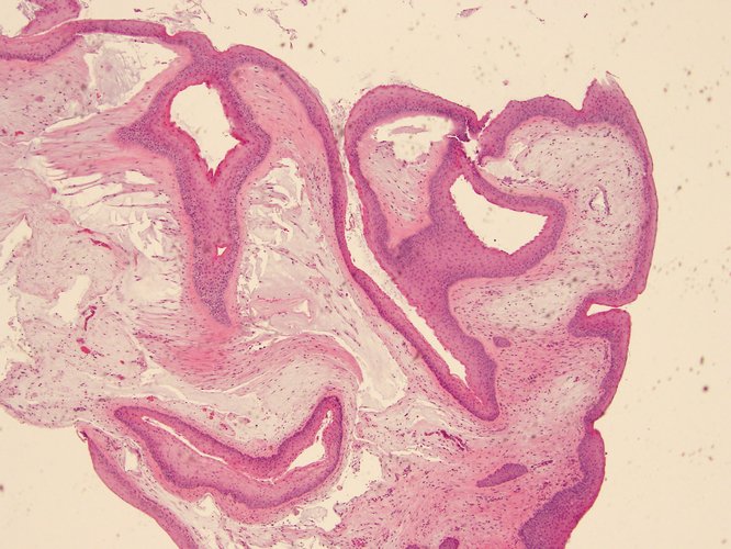 How Can I Tell If I Have Vocal Nodules