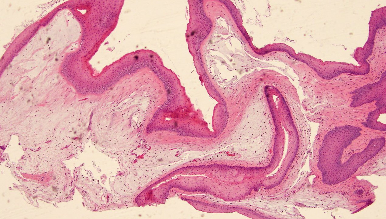 Vocal Cord Nodules
