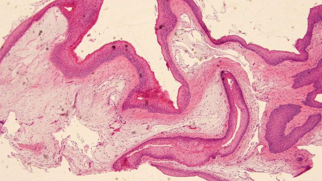 Vocal Cord Nodules