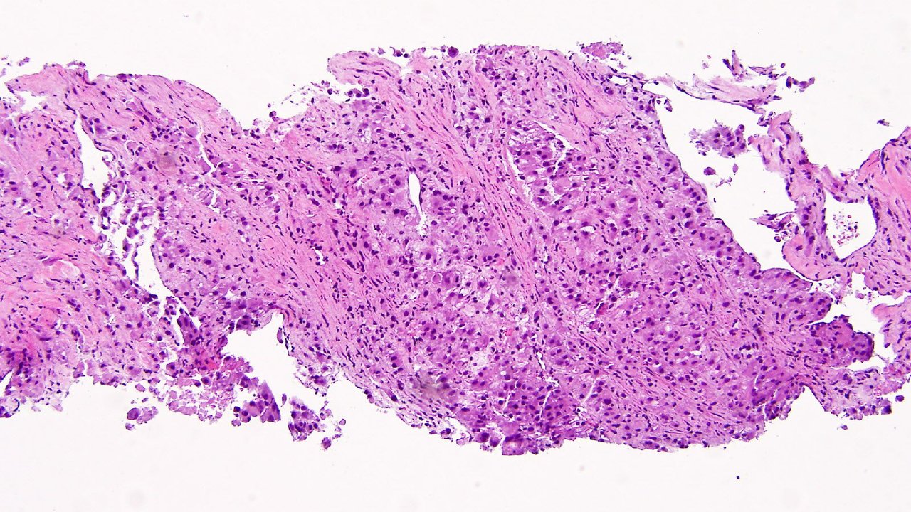 Invasive Mucinous Adenocarcinoma of Lung