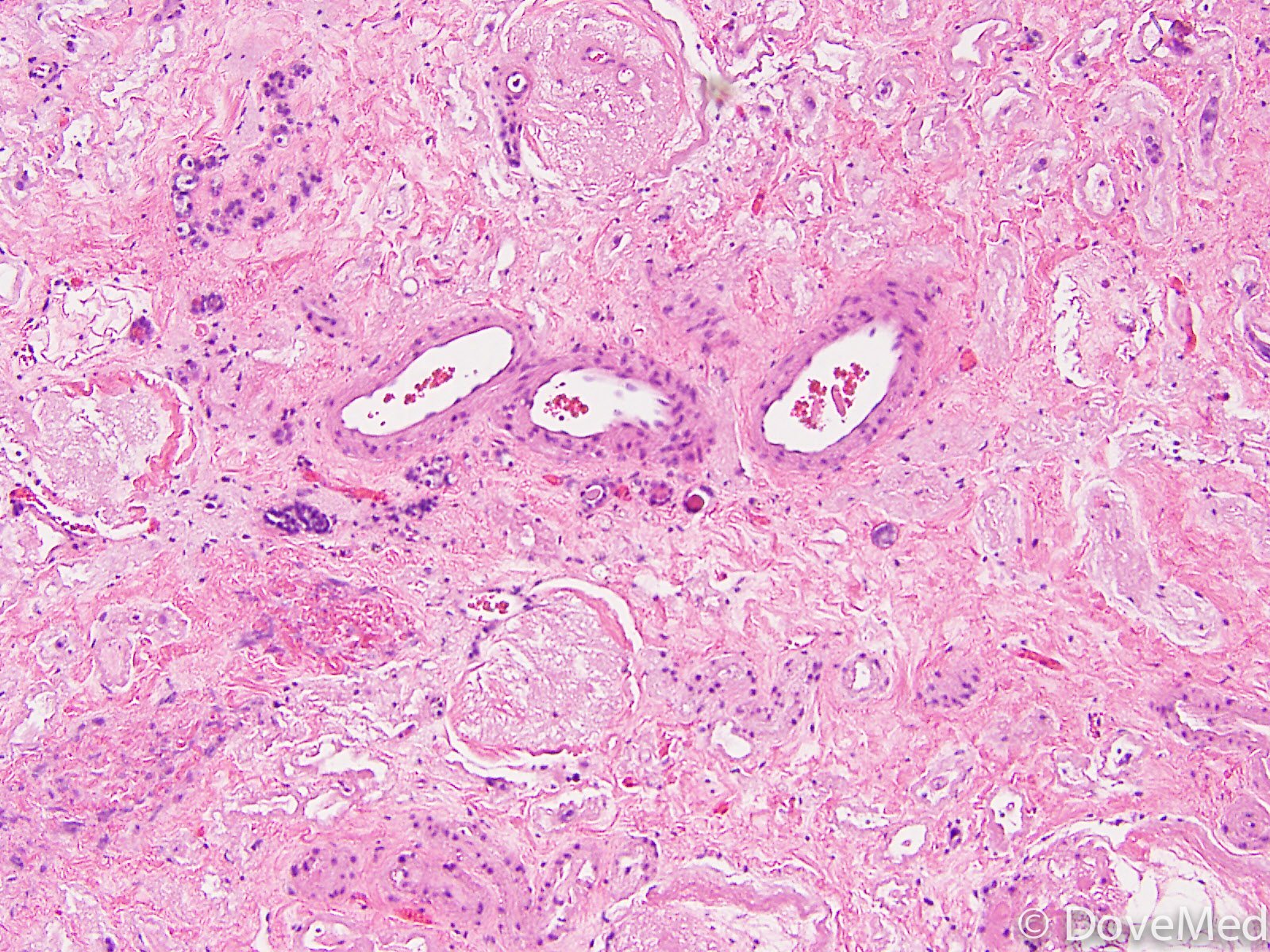 Arteriovenous Malformation of the Brain