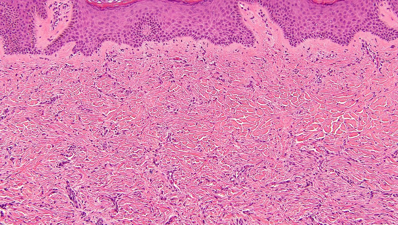Dermatofibroma