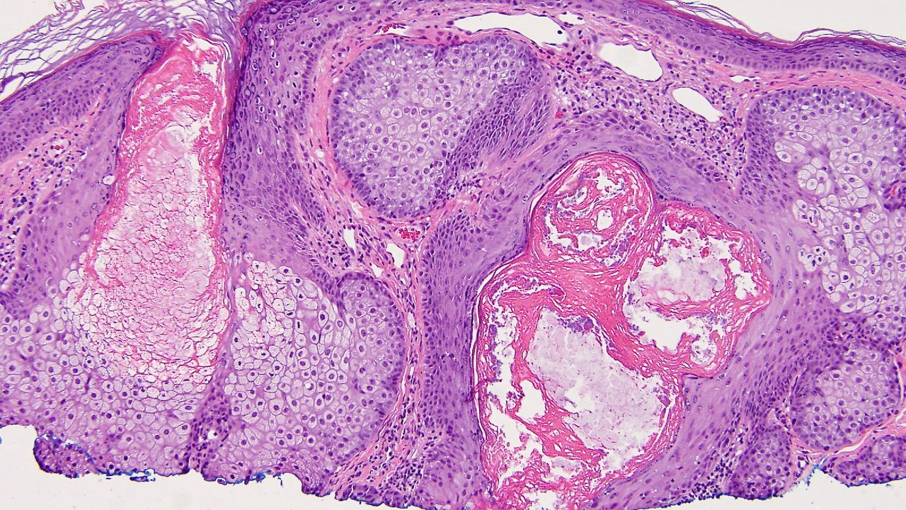 Sebaceous Hyperplasia